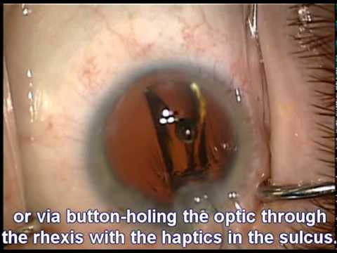 Cataract Surgery by Uday Devgan MD of Los Angeles after prior ...