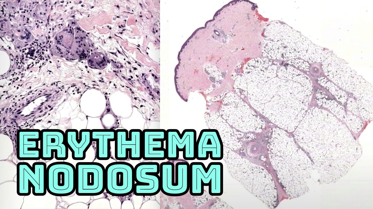 Erythema Nodosum (painful red bumps/lumps on legs panniculitis fat ...
