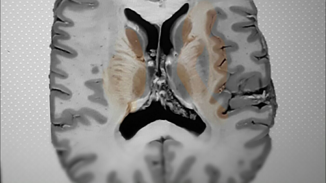 Neuroanatomy - Internal, External and Extreme Capsule Orientation - YouTube