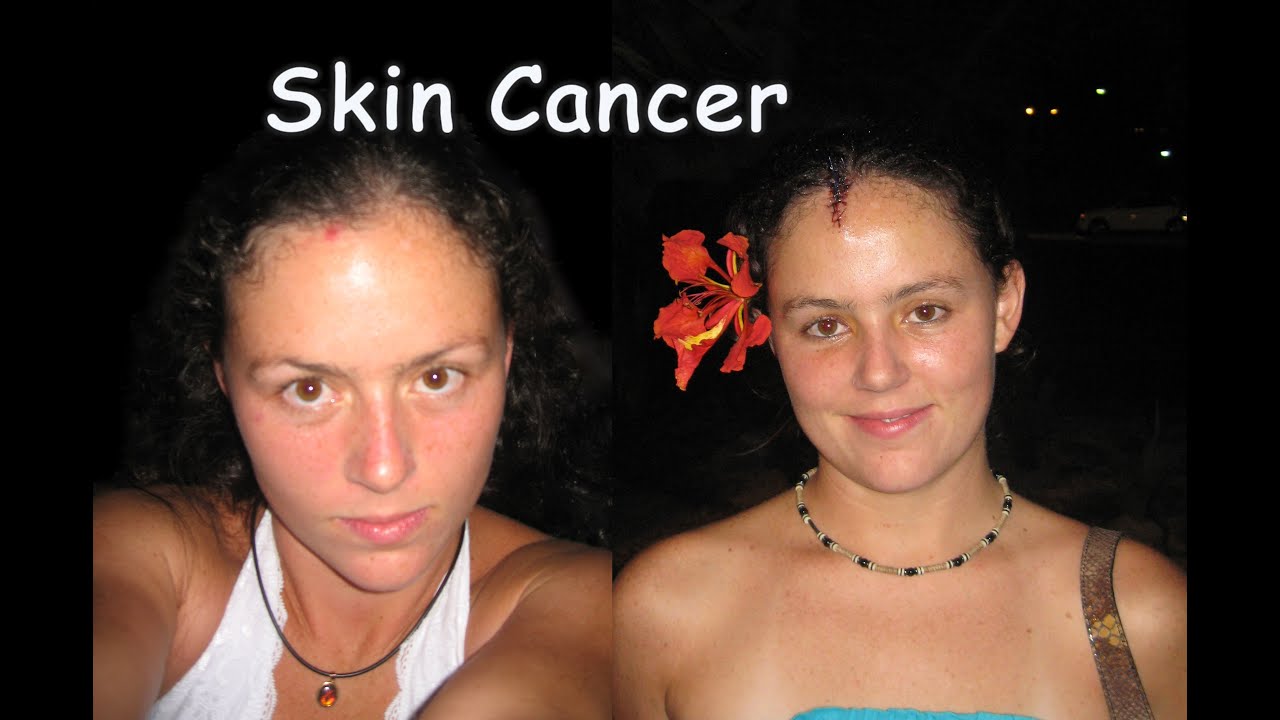 Sun Damage: Skin Cancer Exposed - YouTube