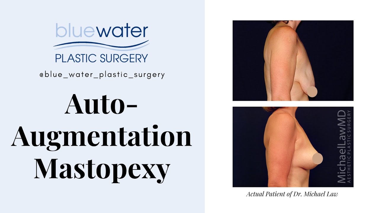 Auto Augmentation Mastopexy by Michael Law MD - YouTube
