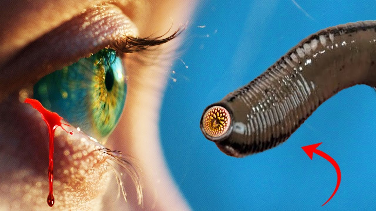 What Happens if a LEECH Attaches Itself to Your EYE? - YouTube