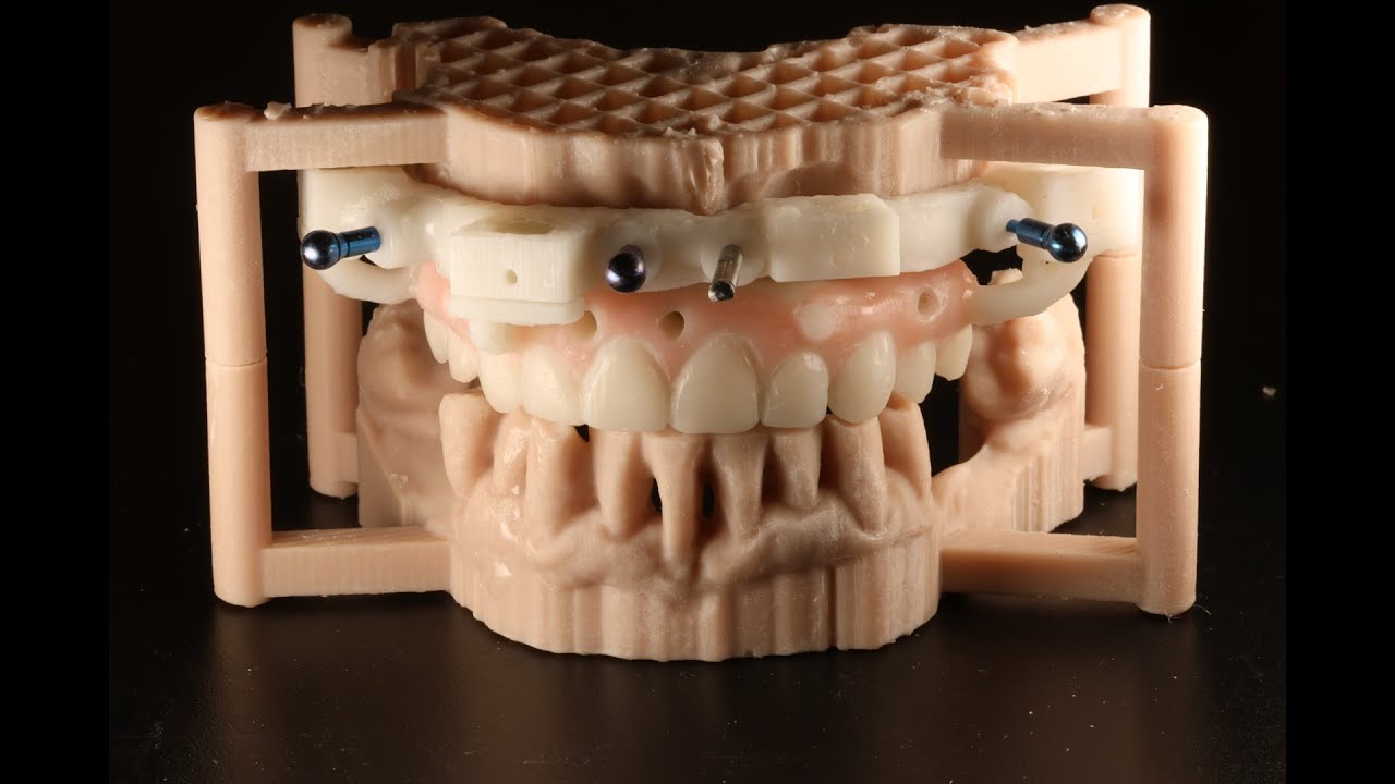 Another Way To Make Mounted Dental Models For 3D Printing using Blue ...