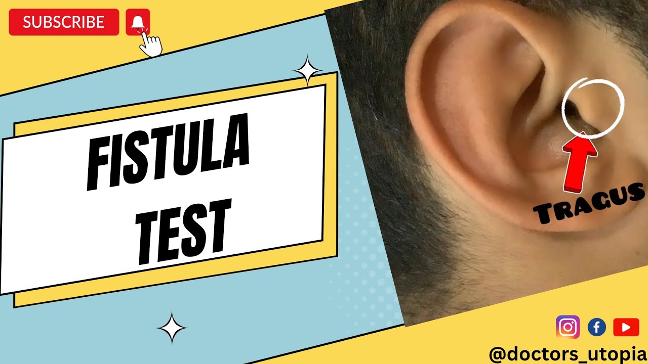 FISTULA TEST | ENT | NEET-PG, FMGE, NExT, USMLE, PLAB, AMC ...