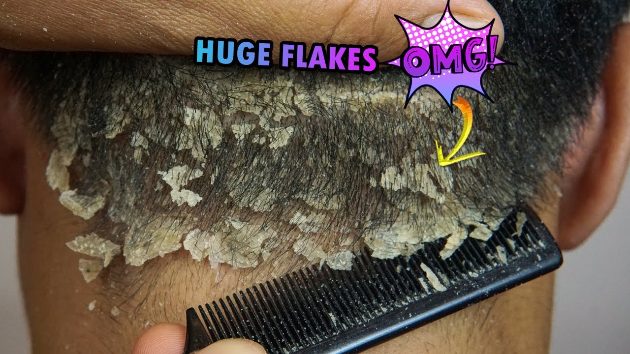 OMG! Huge Dandruff Flakes Removal On Back Side #490 - YouTube