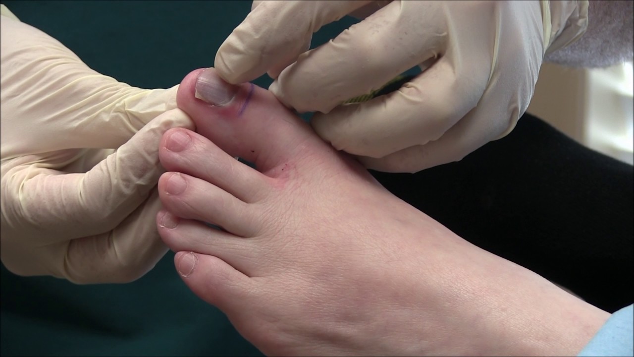 Crushing Injury To Toenail YouTube crushing-injury-to-toenail-youtube