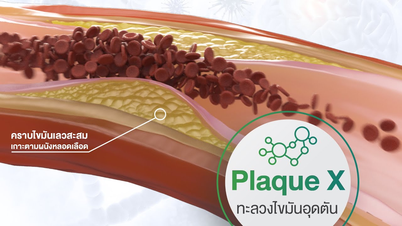 กำจัดไขมันอุดตันในหลอดเลือด ด้วย Plaque X ที่ Healing Art Vascular ...