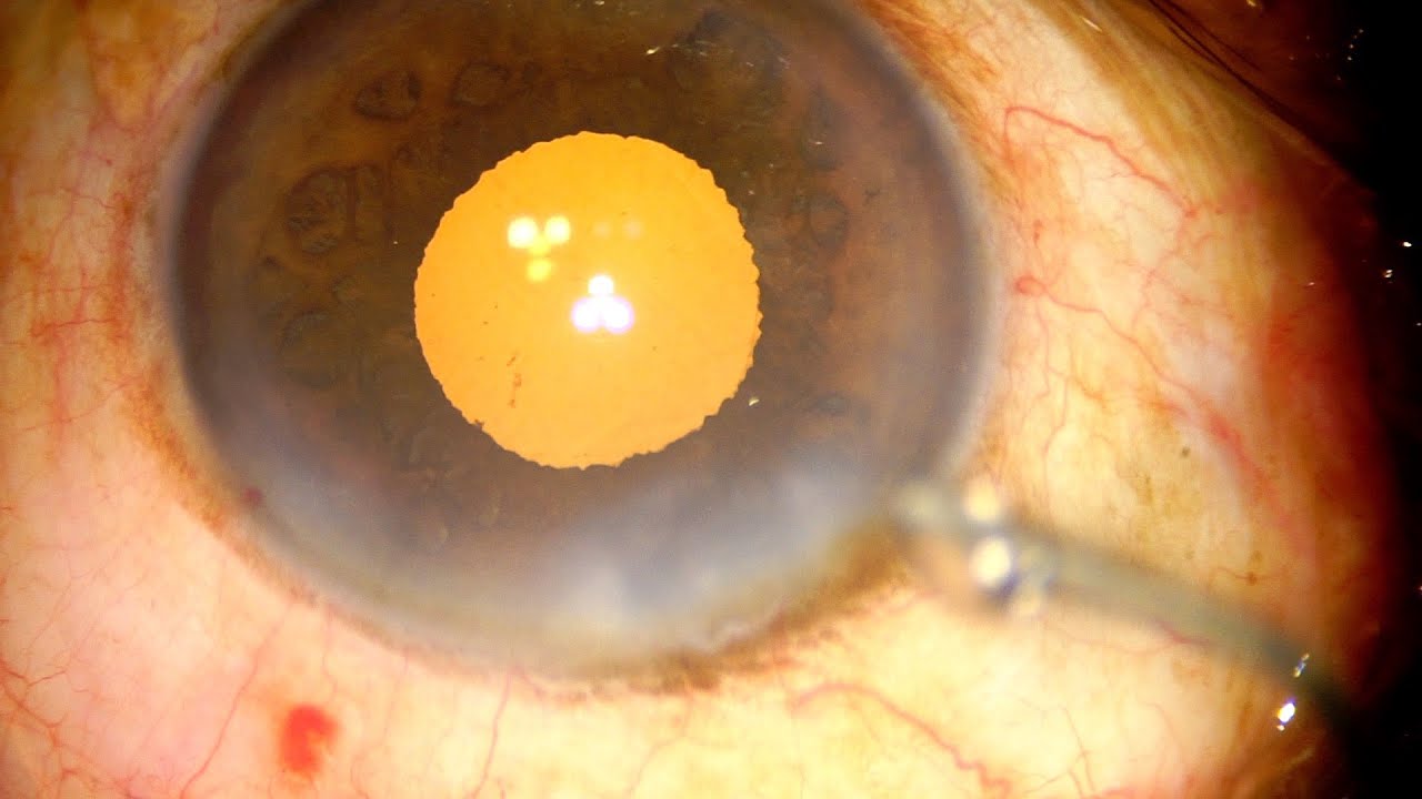 Unedited Phaco in Inadequate Pupil - Dr Ramakrishna Tadanki - YouTube