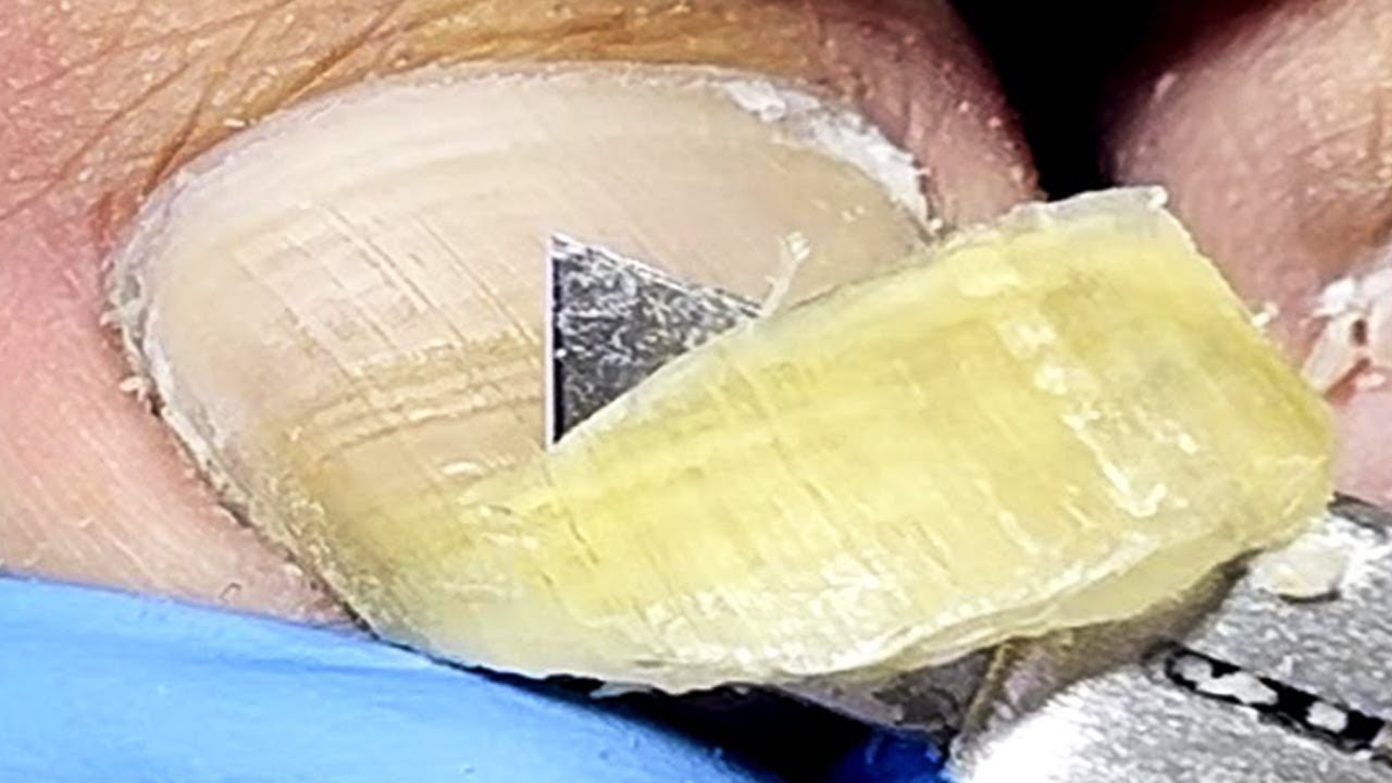 The front part of the nail is infected and needs trimming【Pedicure King ...