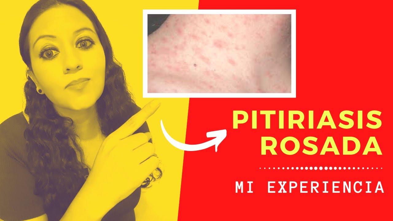 PITIRIASIS ROSADA MI EXPERIENCIA l DERMATOLOGICO PASCUA - YouTube