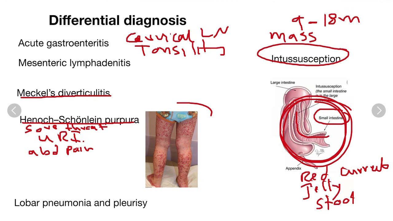 Vermiform appendix lecture 1 / part 2 - YouTube