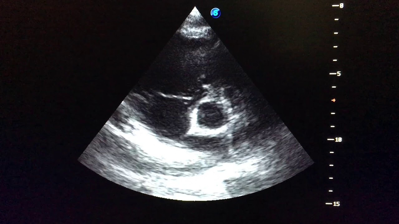 Unicuspid aortic valve with severe aortic stenosis - YouTube