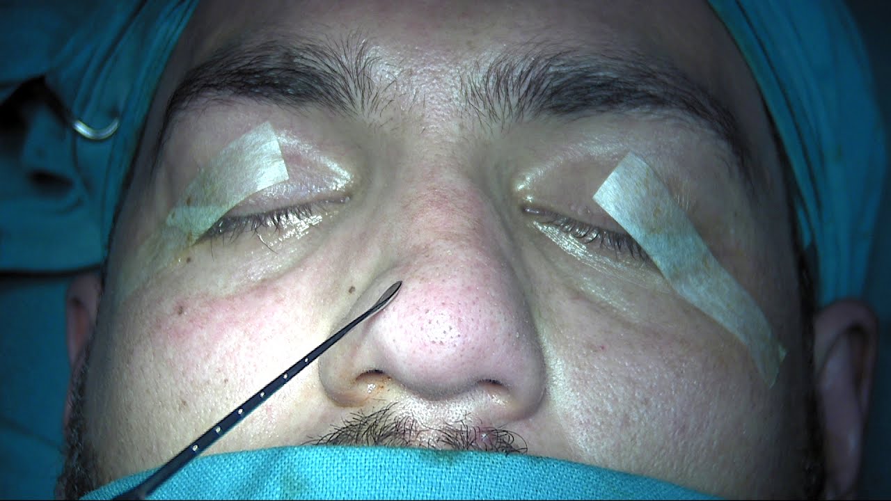 Primary Extra Corporeal Septo-Rhinoplasty for External Nasal Deviation ...