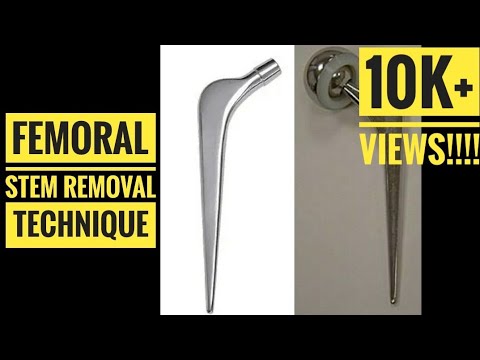 Femoral Stem Removal Technique (THR or Hemiarthoplasty) - YouTube
