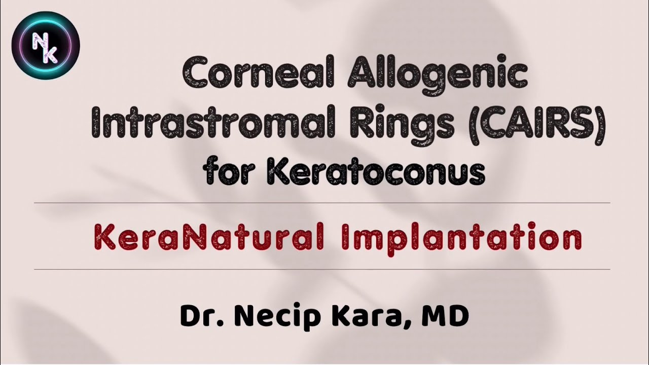 Corneal Allogenic Intrastromal Rings (CAIRS) for Keratoconus ...