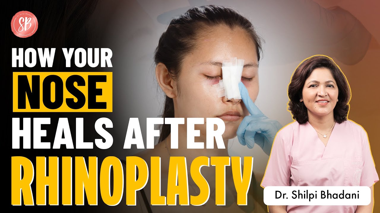 Rhinoplasty: Recovery, Surgery Cost, Aftercare | Nose Job Surgery ...