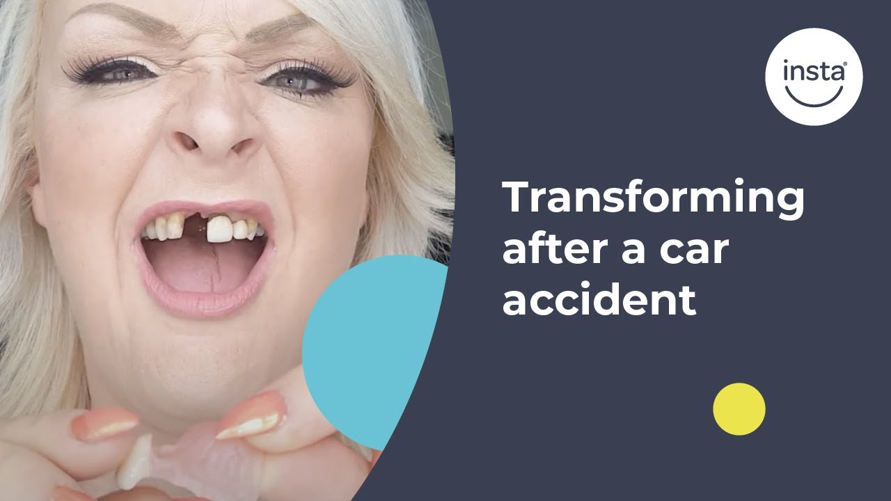Perfect Smile Transformation After Car Accident | Instasmile Review ...