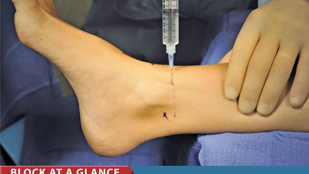 Ankle block.procedure and technique step by step in pashto. - YouTube