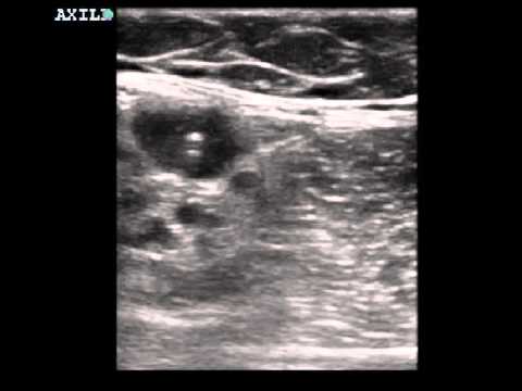 Upper Extremity DVT associated with PICC line - YouTube