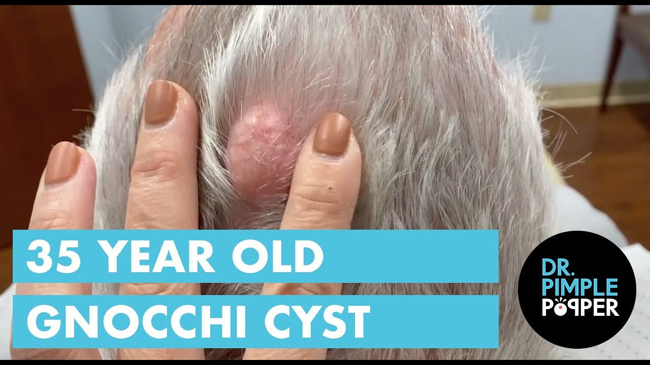 35 Year Old Gnocchi Pilar Cyst - YouTube