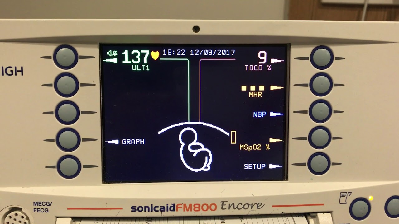 Baby on the ECG machine - YouTube