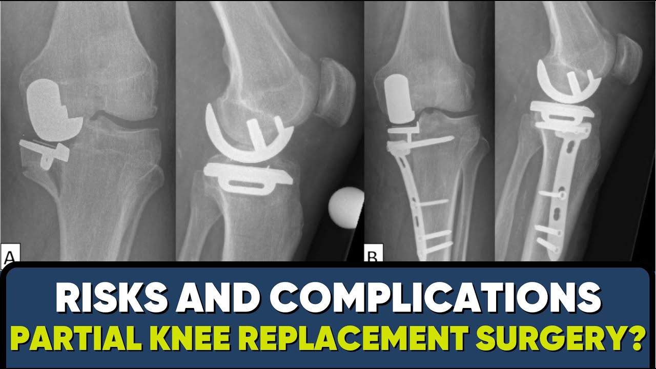 RISKS & COMPLICATIONS of UKR? (Partial Knee Replacement Surgery) - YouTube