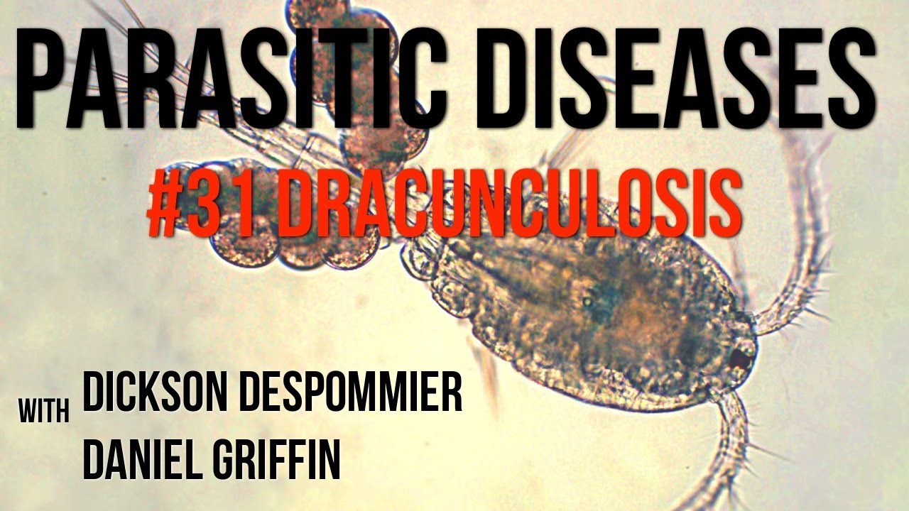 Parasitic Diseases Lectures #31: Dracunculosis - YouTube