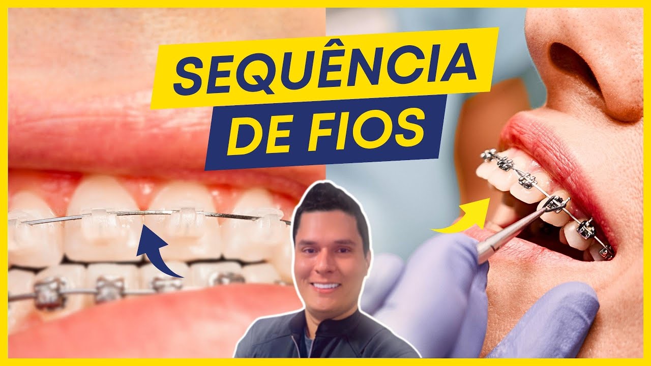 QUAL A SEQUÊNCIA DE FIOS IDEAL EM UM TRATAMENTO ORTODÔNTICO? - YouTube