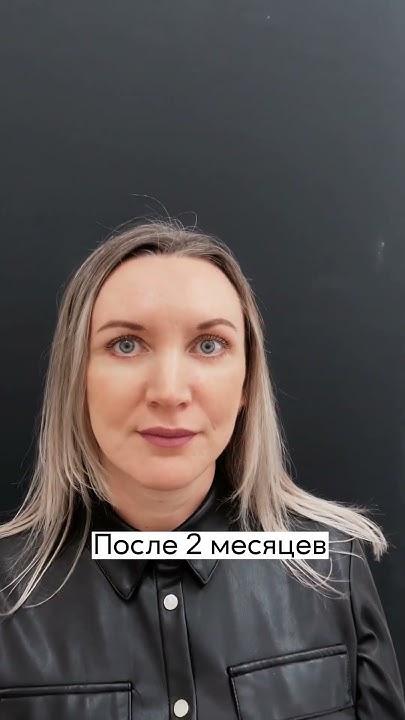 ПЛАСТИЧЕСКАЯ ОПЕРАЦИЯ БЛЕФАРОПЛАСТИКА ПОДТЯЖКА ЛИЦА РЕЗУЛЬТАТ ДО