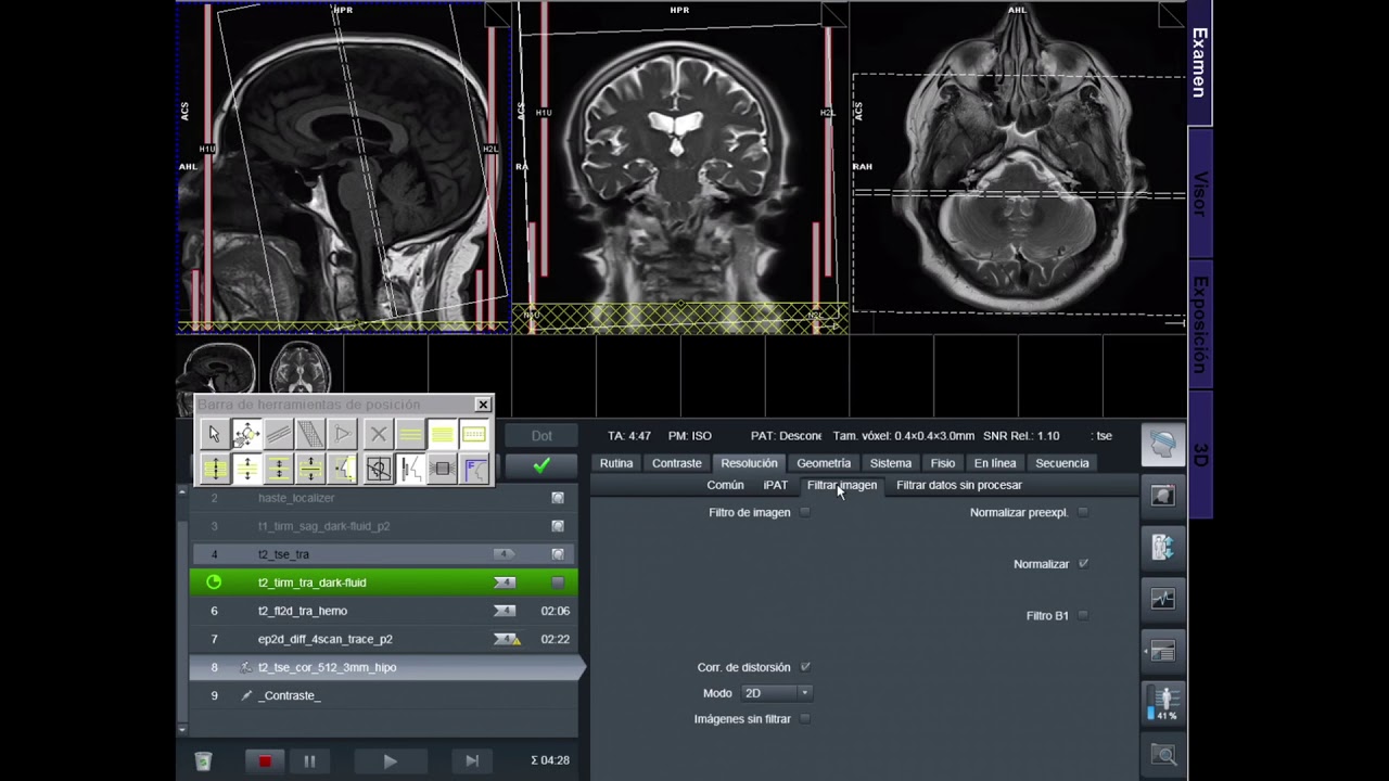 PROTOCOLO RM CEREBRO DETERIORO COGNITIVO - YouTube