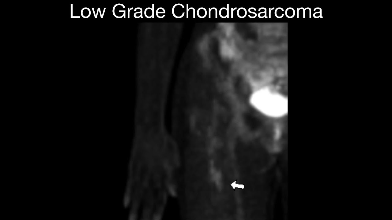 Low Grade Chondrosarcoma - YouTube