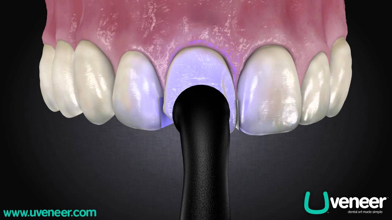 Composite Veneers- Uveneer is the easiest and fastest - YouTube