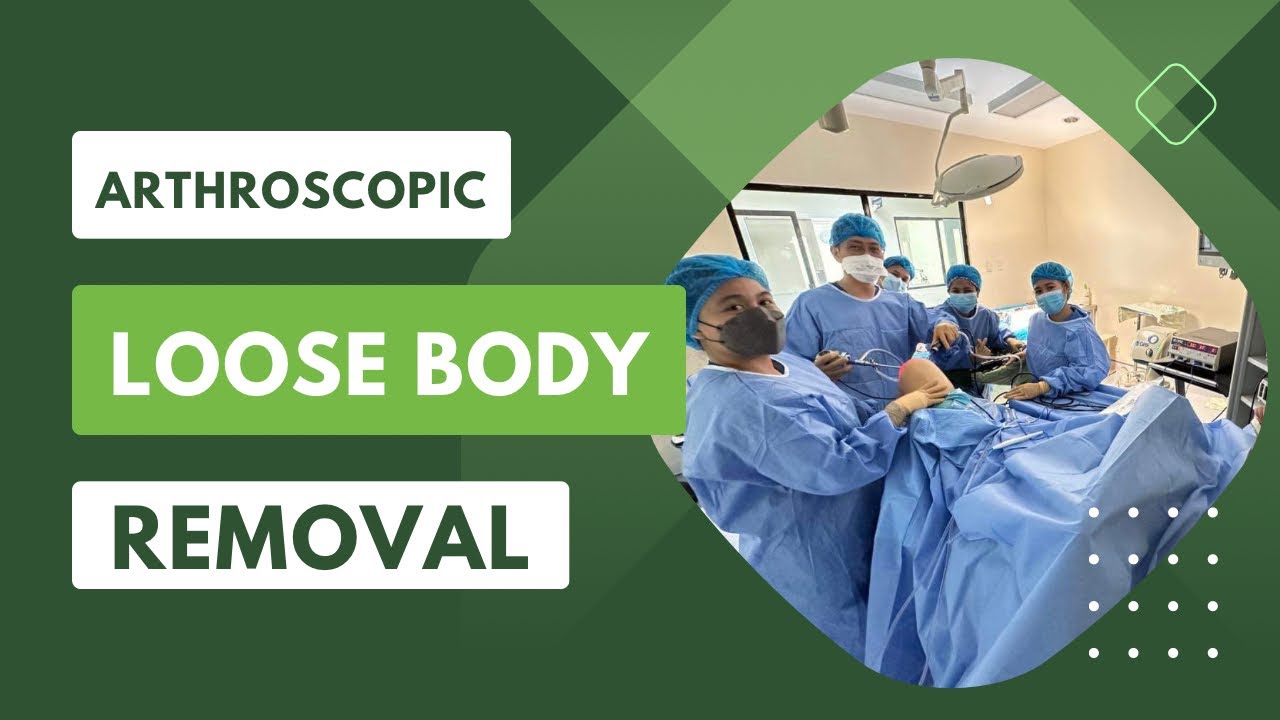 Arthroscopic removal of a large primary bone tumor | Osteochondroma ...