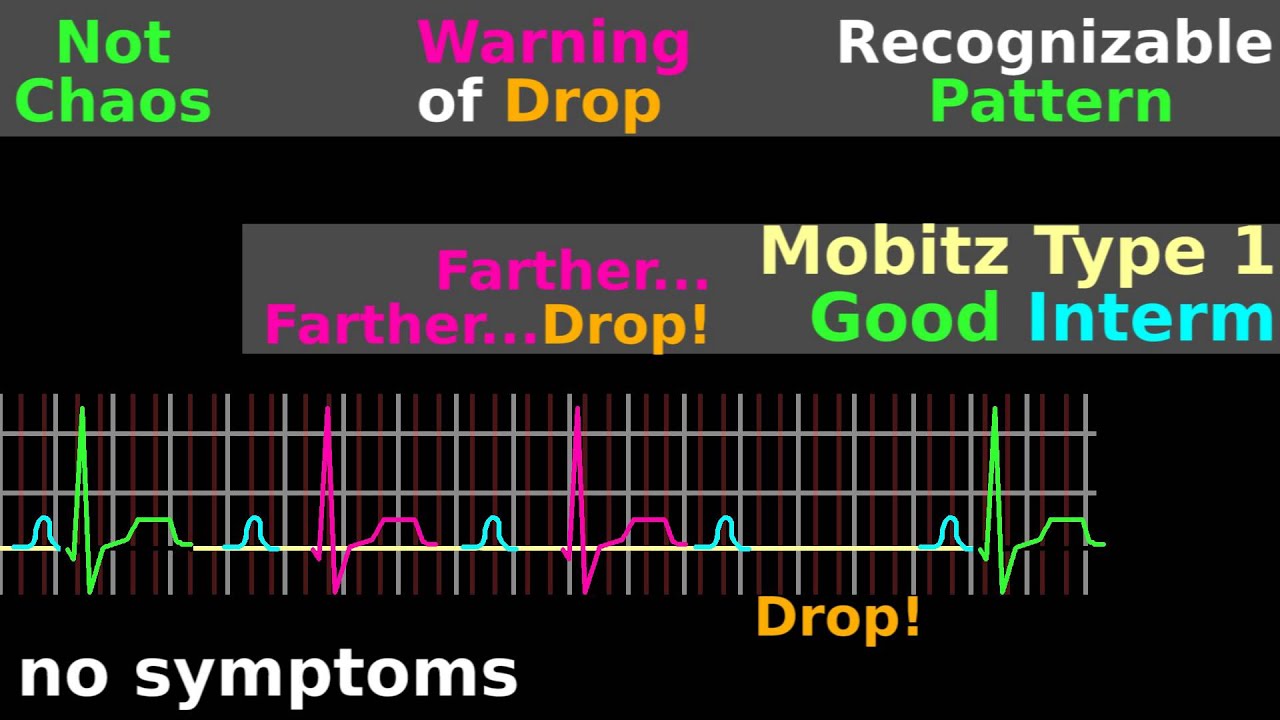 ECG Tutorial: AV block EKG Mobitz electrocardiogram interpretation ...