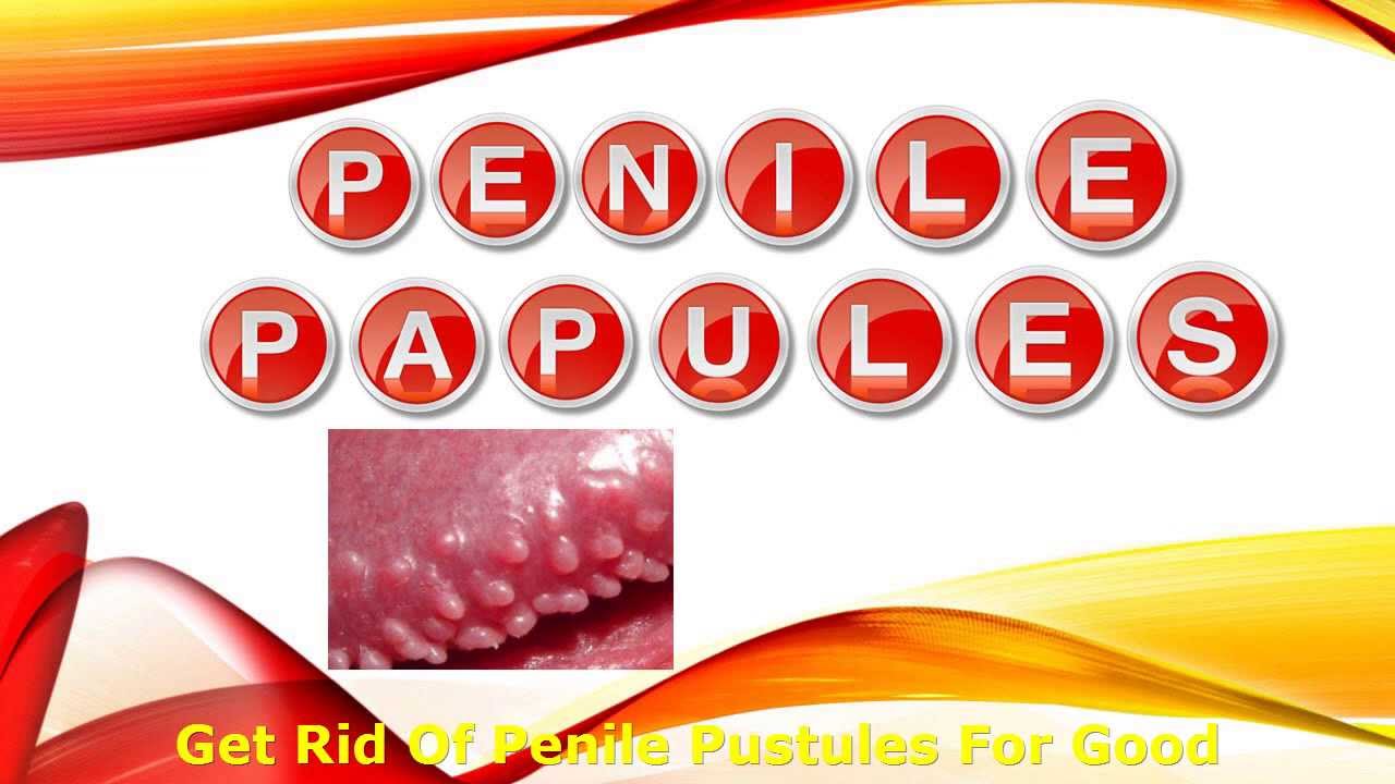 Remove Papules Rapidly No Surgey Laser Required - YouTube
