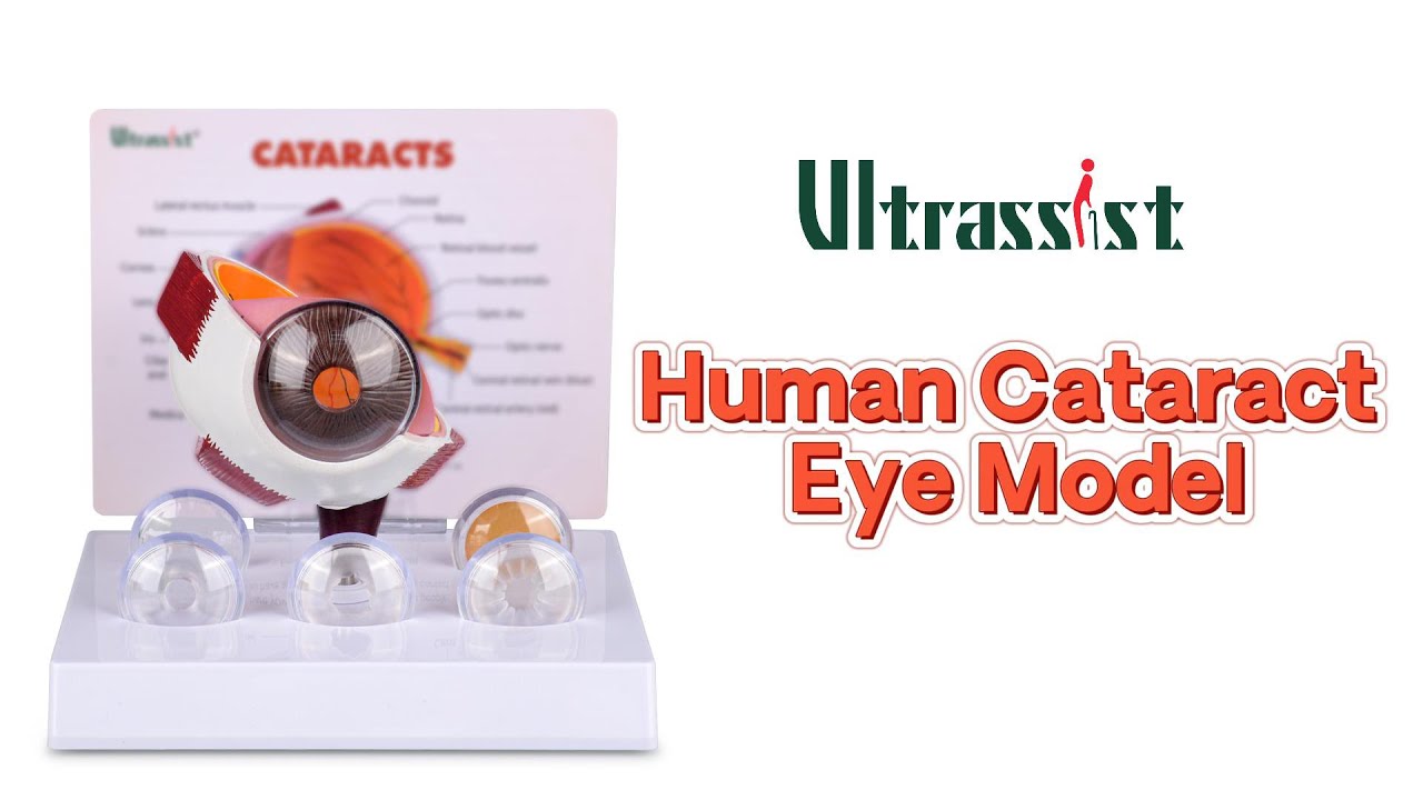 Enlarged Human Cataract Eye Anatomy Model for Ophthalmology Education ...