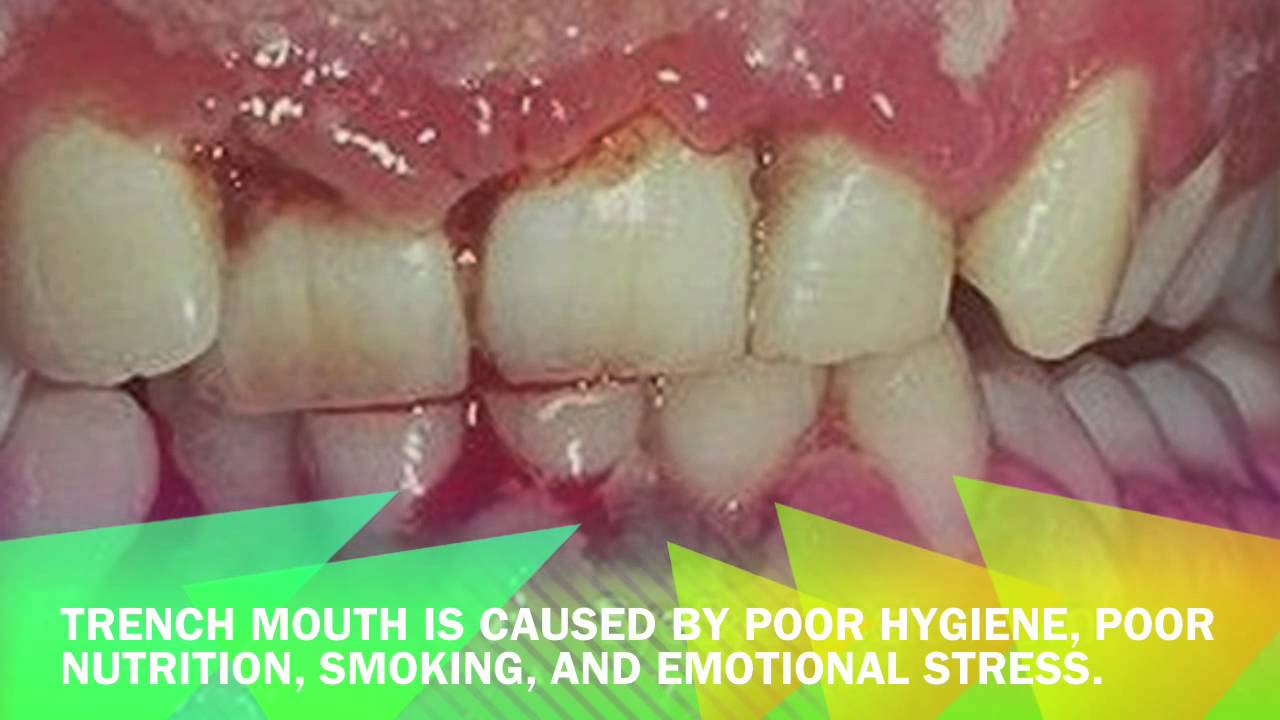 Trench Foot And Trench Mouth - YouTube