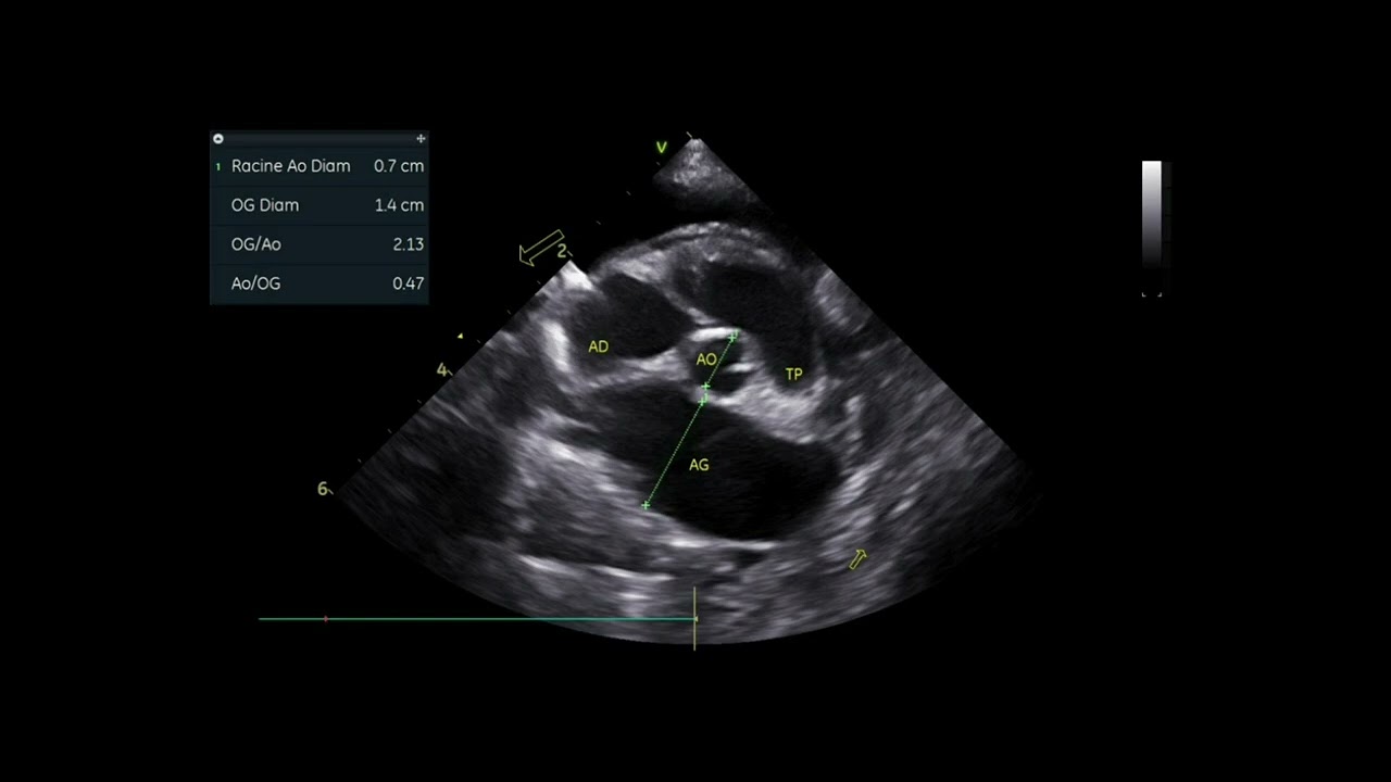 Congestive heart failure secondary to dilated cardiomyopathy (DCM) in 8 ...