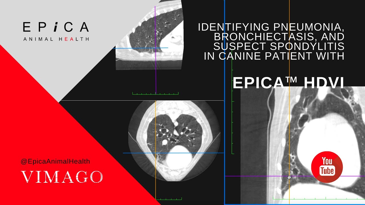 Identifying Pneumonia, Bronchiectasis, and Suspect Spondylitis in ...