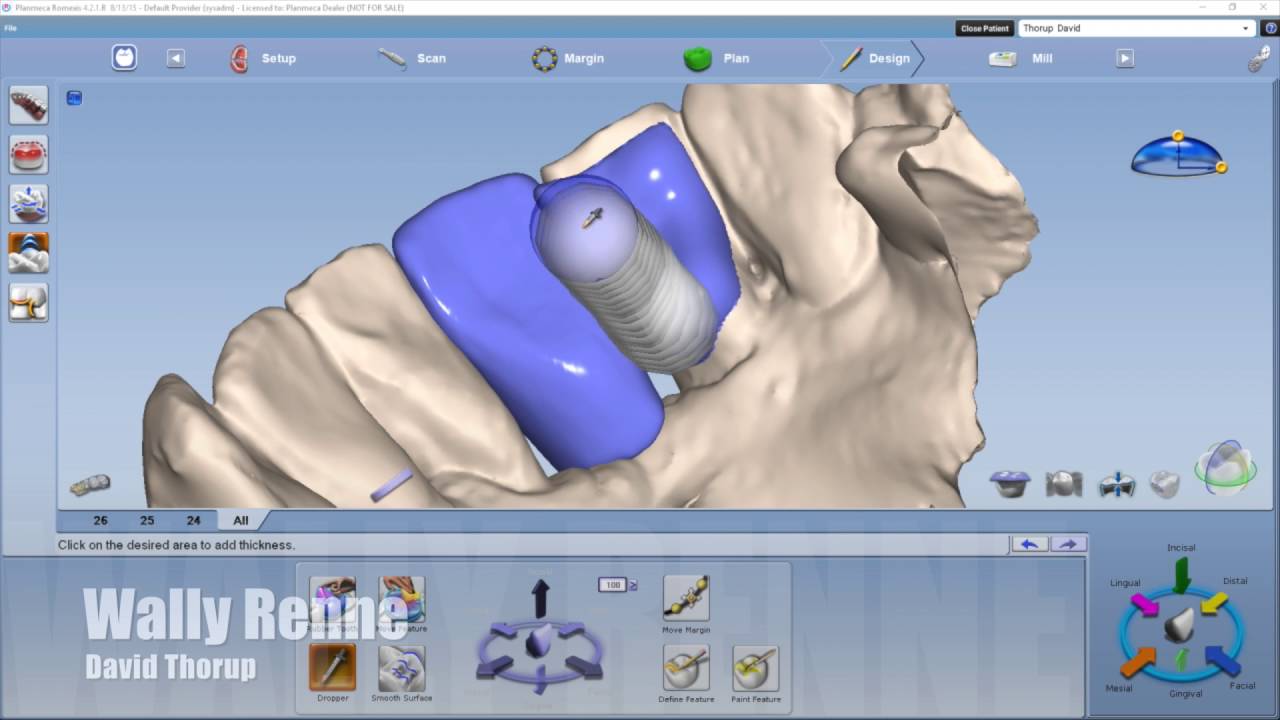 Planscan emax adhesion bridge - YouTube