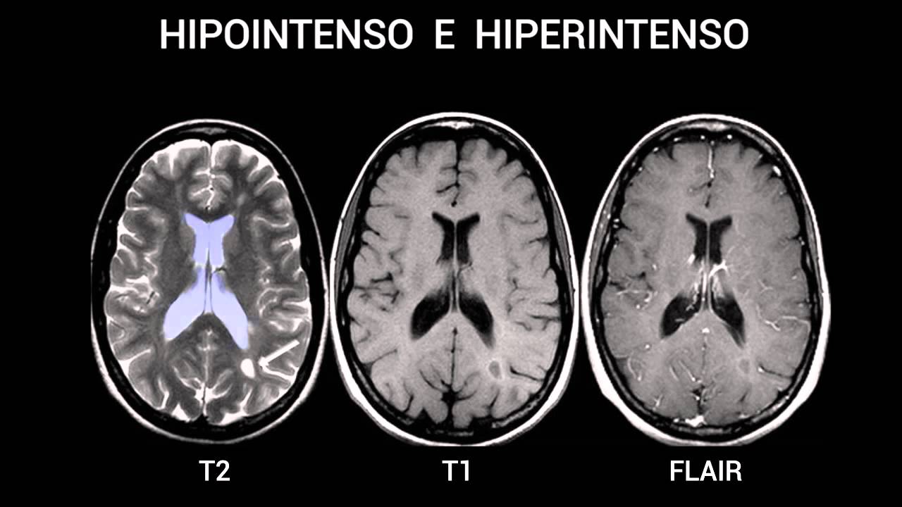 Hipointenso E Hiperintenso En Resonancia - BRAINCP Hipointenso E Hiperintenso En Resonancia - BRAINCP