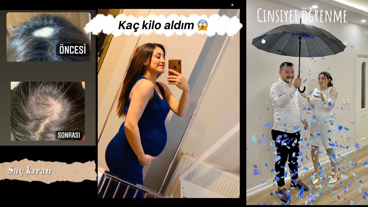 Hamilelik Sürecim 13 Kilo Aldım Vitamin Eksikliği Kanama Saçkıran