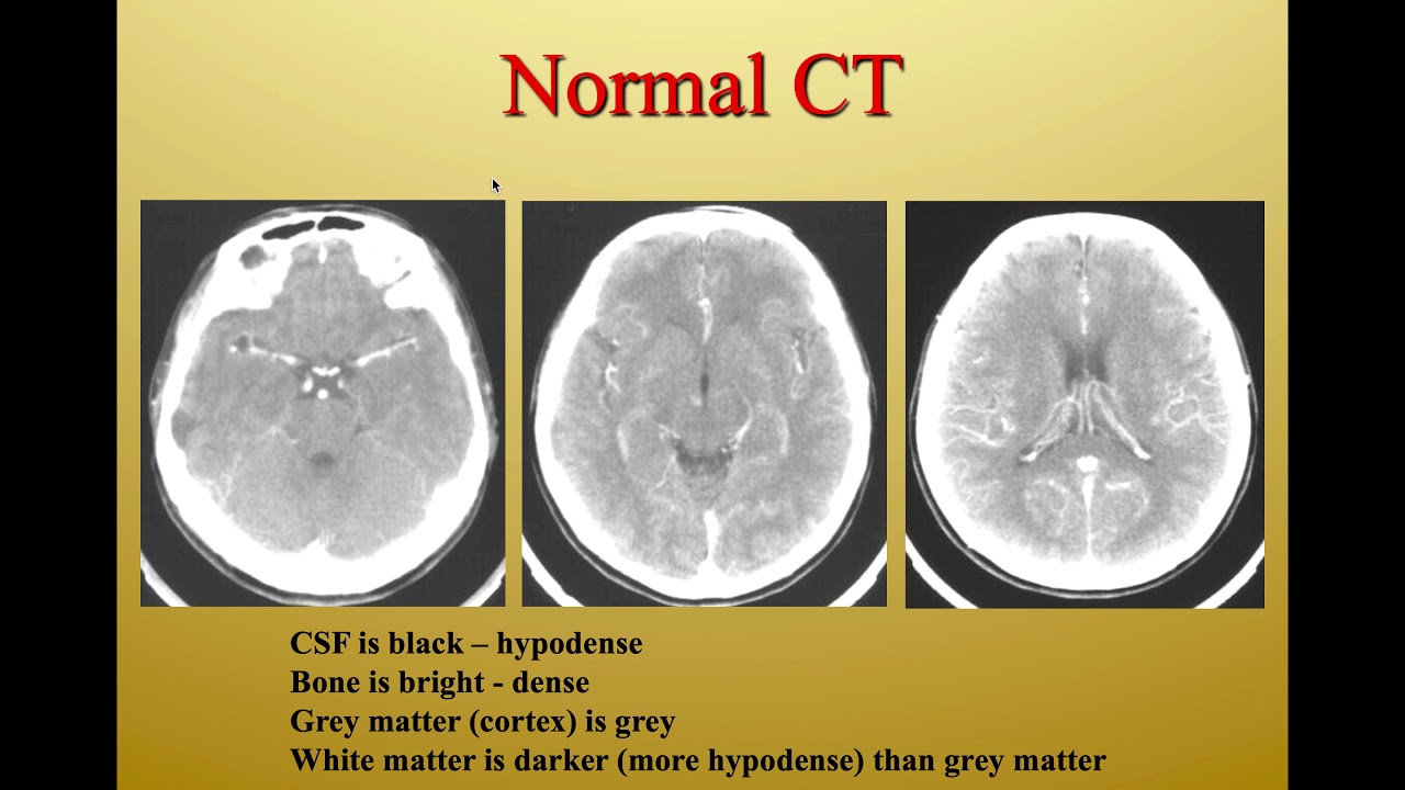 Paediatric Brain Imaging for Medical Undergraduates - YouTube
