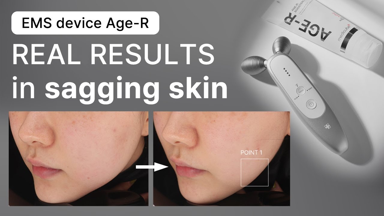Age-R Device: Experience verified & proven results in sagging skin ...