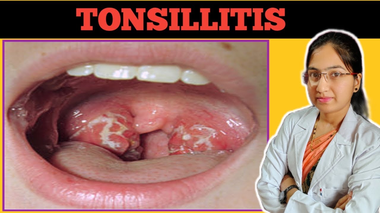 Tonsillitis | Throat Infection | Tonsils | ENT | Causes | Symptoms ...