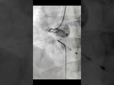 Primary Angioplasty to LAD and RCA with TPI (Temporary Pacemaker Insertion ).Plan : Recheck CAG ...