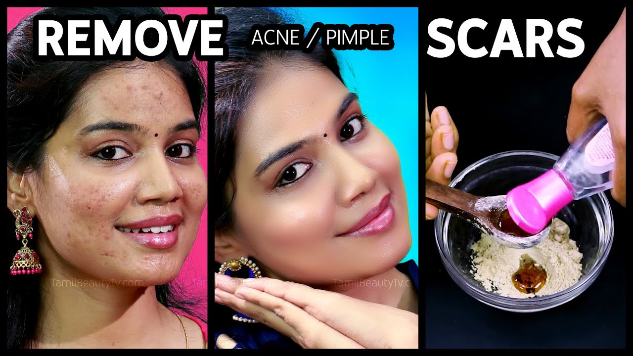 Acne Scars Home Remedies In Tamil Pimple Marks Removal At Home YouTube acne-scars-home-remedies-in-tamil-pimple-marks-removal-at-home-youtube