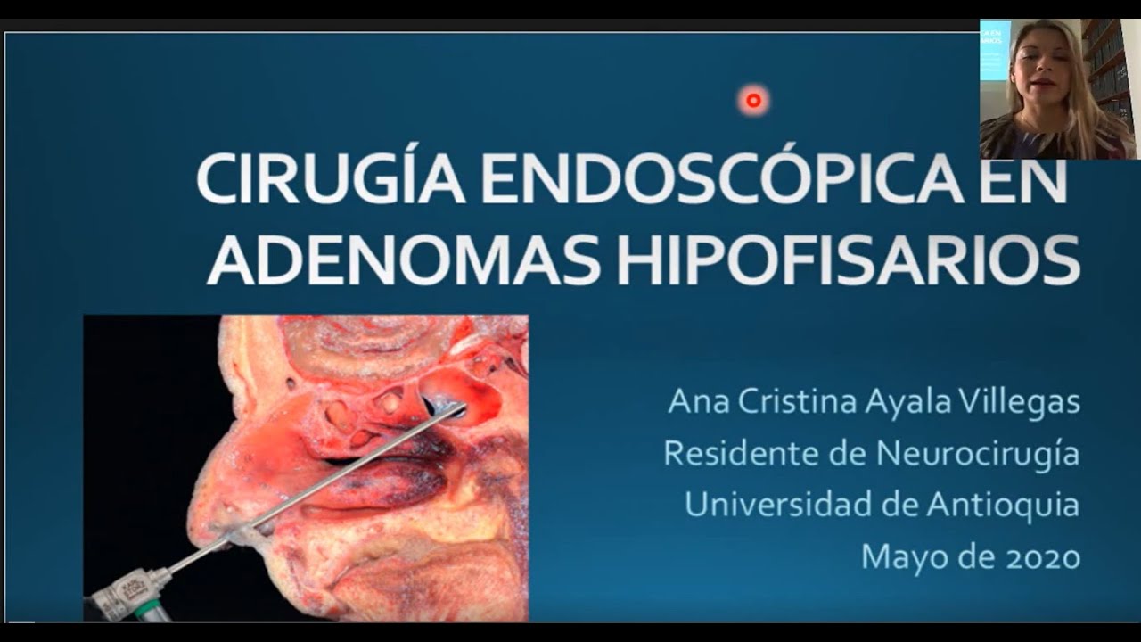 Cirugía Endoscópica De Hipófisis Youtube