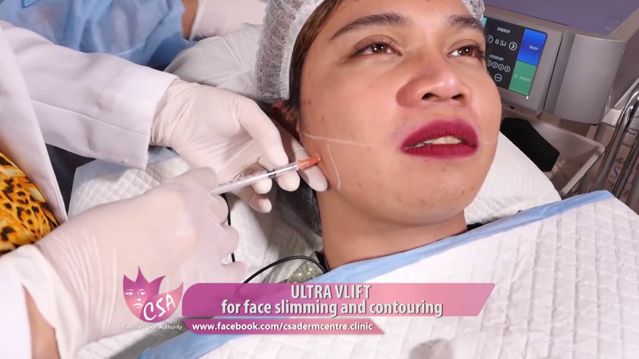 Ultra V Lift for face slimming and face contouring - YouTube