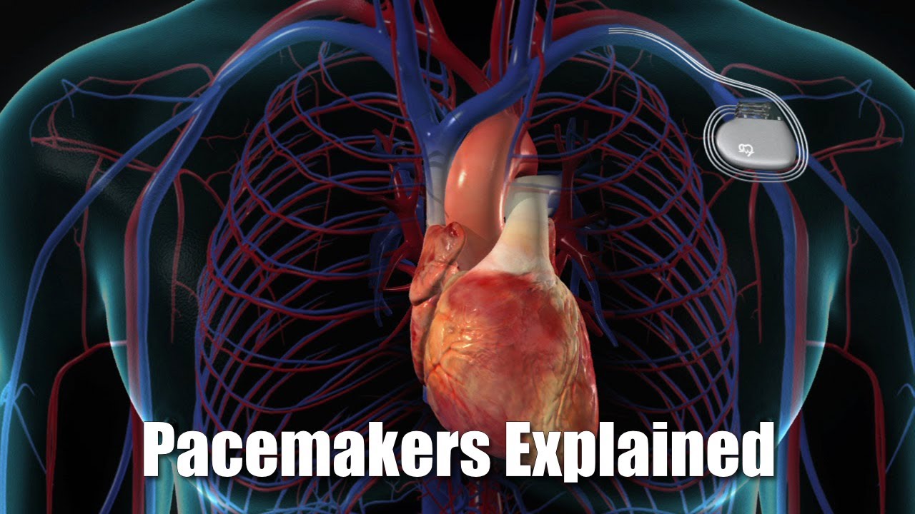 How a pacemaker regulates your heartbeat - YouTube